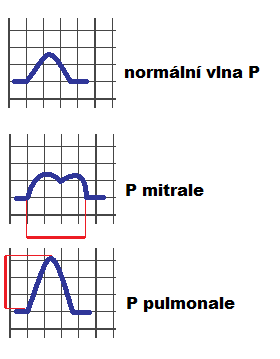 Popis EKG – WikiSkripta
