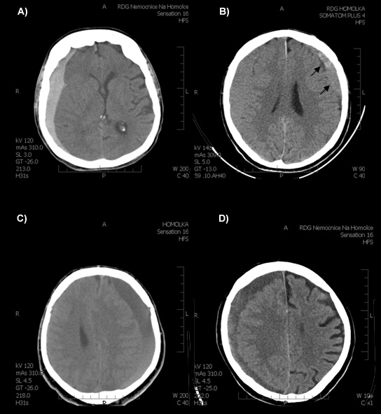 Akutní subdurální hematom – WikiSkripta