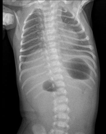 Vrozené vady gastrointestinálního traktu – WikiSkripta