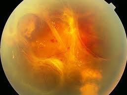 Odchlípení sítnice – WikiSkripta