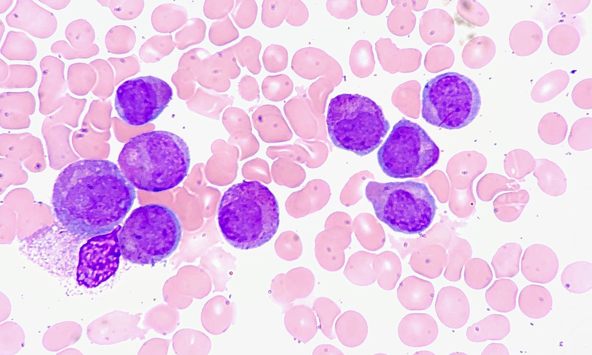 Akutn Promyelocyt rn Leukemie WikiSkripta Akutn Promyelocyt rn Leukemie WikiSkripta