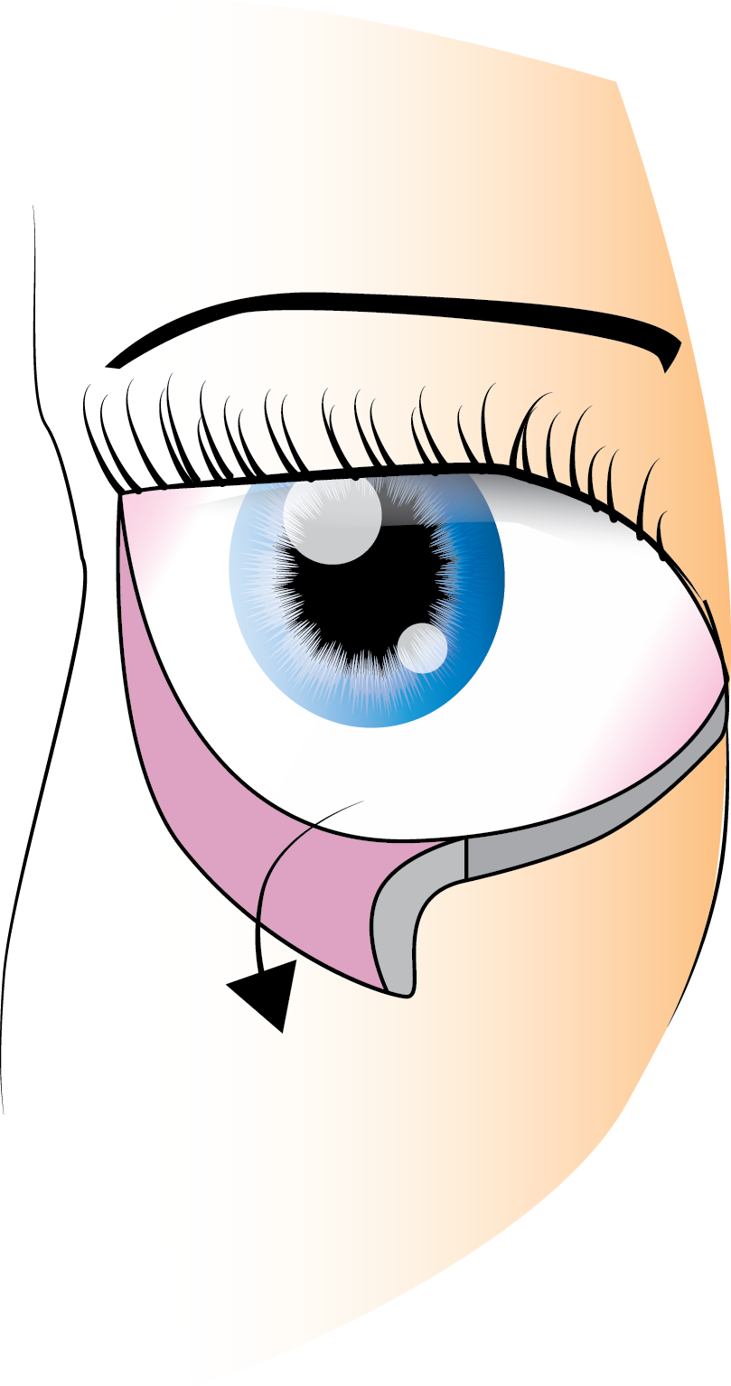 Ektropium (oftalmologie) – WikiSkripta