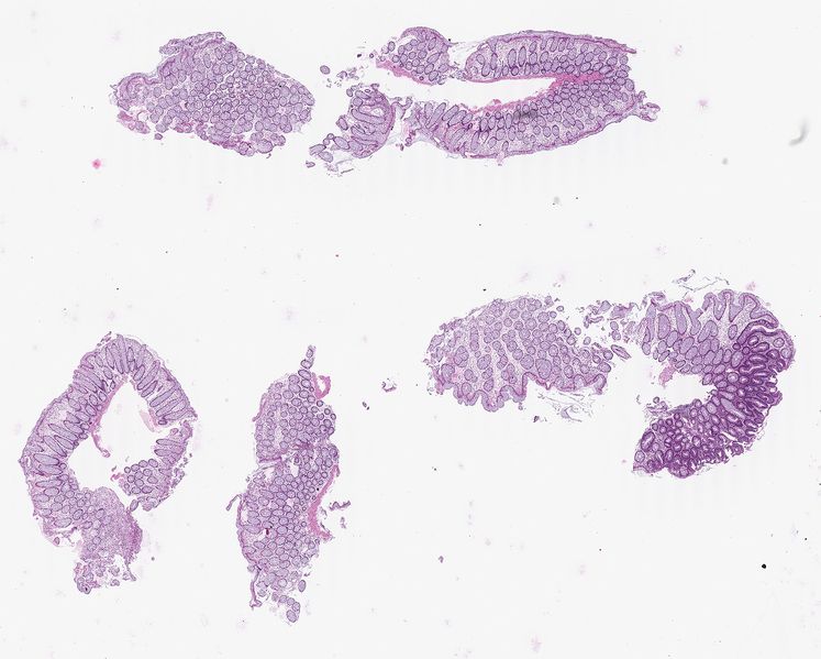 Kolorektální adenom – WikiSkripta