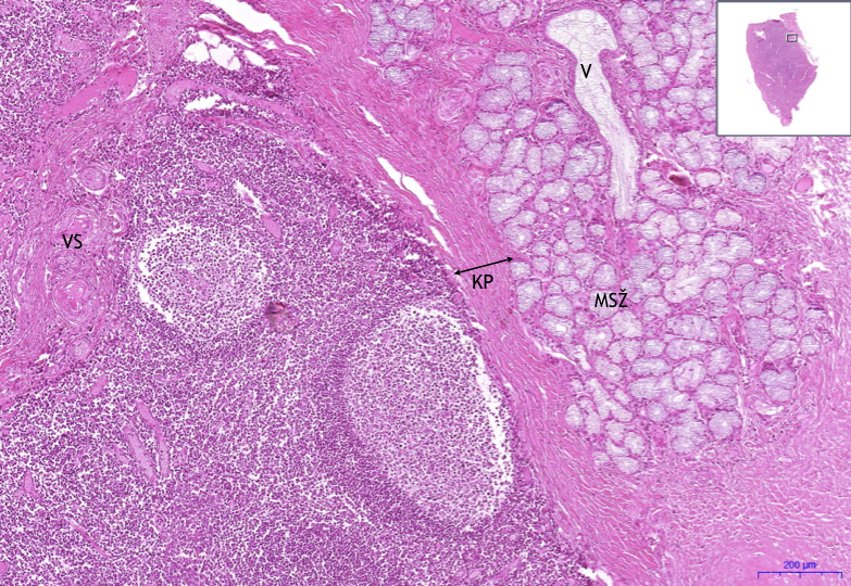 Patrová krční mandle / Tonsila Pallatina - HE – WikiSkripta