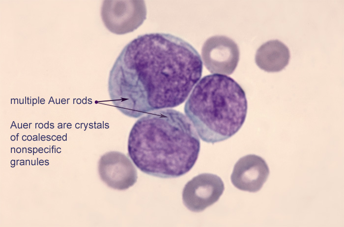 Akutní myeloidní leukemie – WikiSkripta