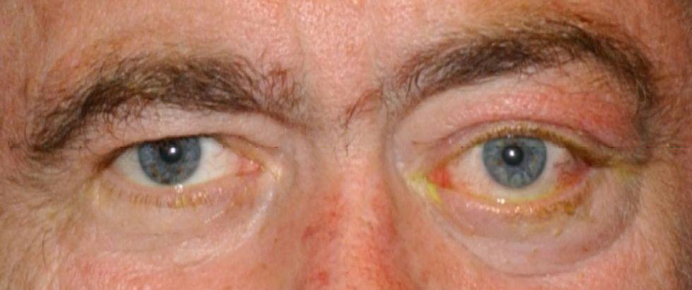 Soubor:Exoftalmus-jednostranný, axiální.jpg – WikiSkripta