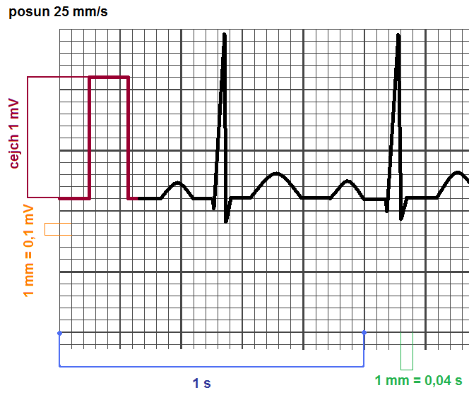 Popis EKG – WikiSkripta