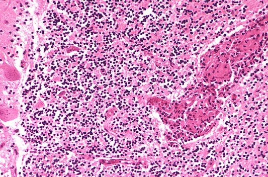 Sarkoidóza nervového systému – WikiSkripta