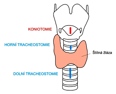 Tracheostomie – WikiSkripta