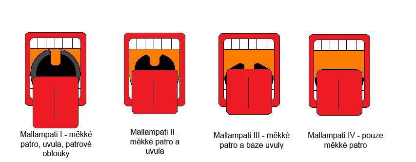 Obtížná intubace – WikiSkripta