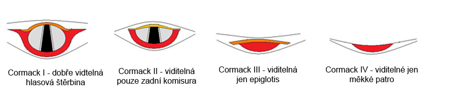 Obtížná intubace – WikiSkripta